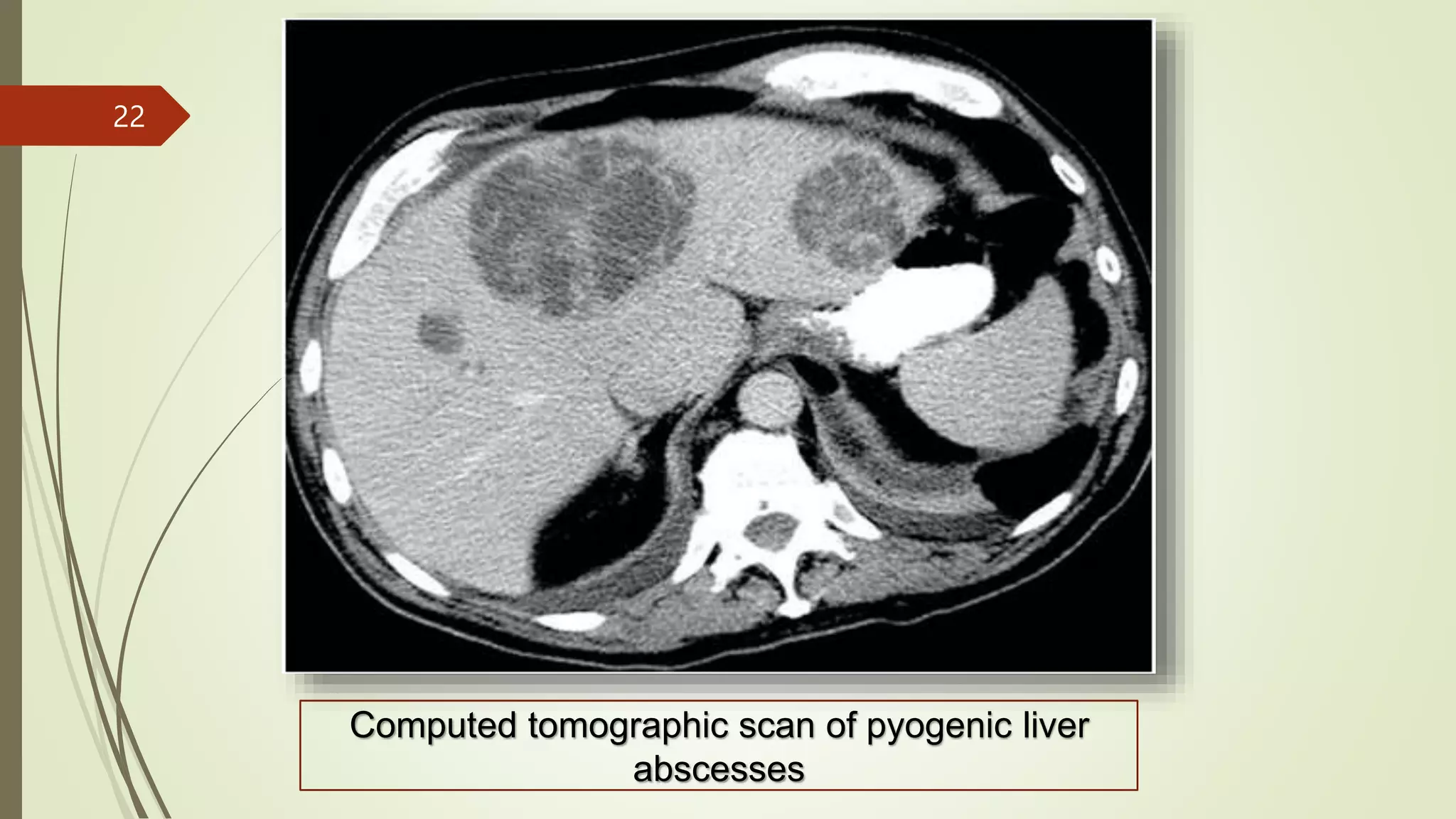 benign lesions of the Liver.pptx