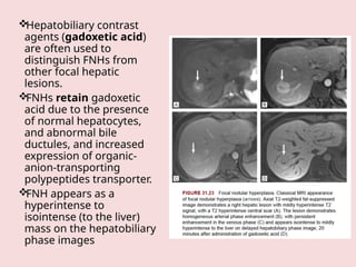 Imaging of benign focal lesions of the Liver | PPTX
