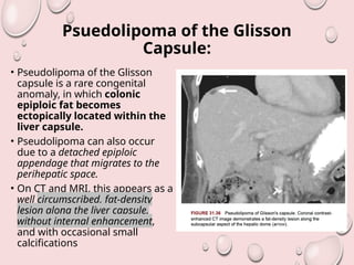 Imaging of benign focal lesions of the Liver | PPTX
