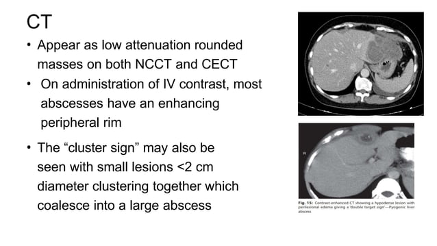 benign liver (focal and diffuse )leisons 1.pptx