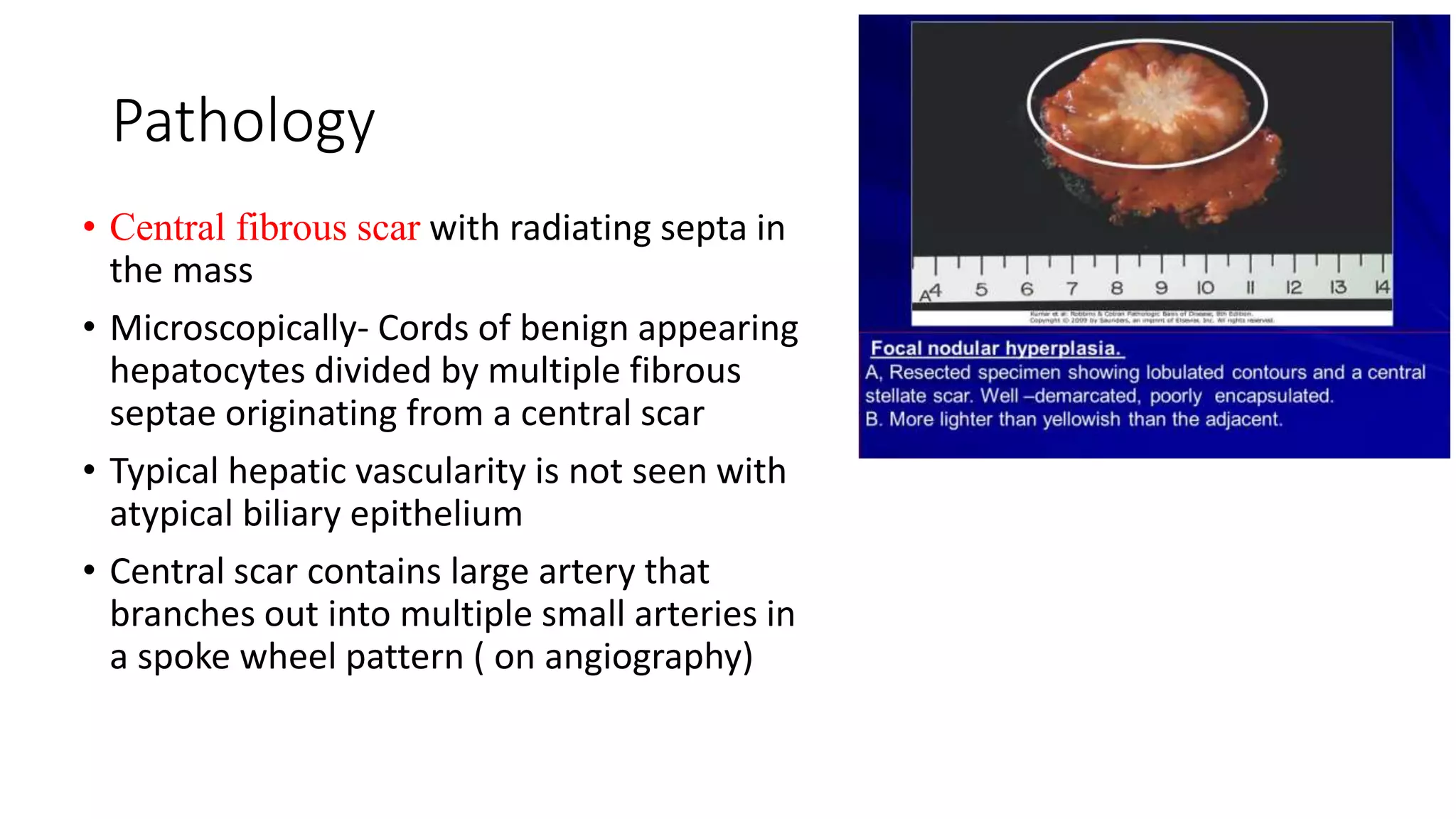 Benign Liver Lesions | PPTX