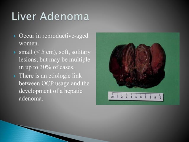 Benign liver lesions | PPTX | Digestive Disorders | Diseases and Conditions