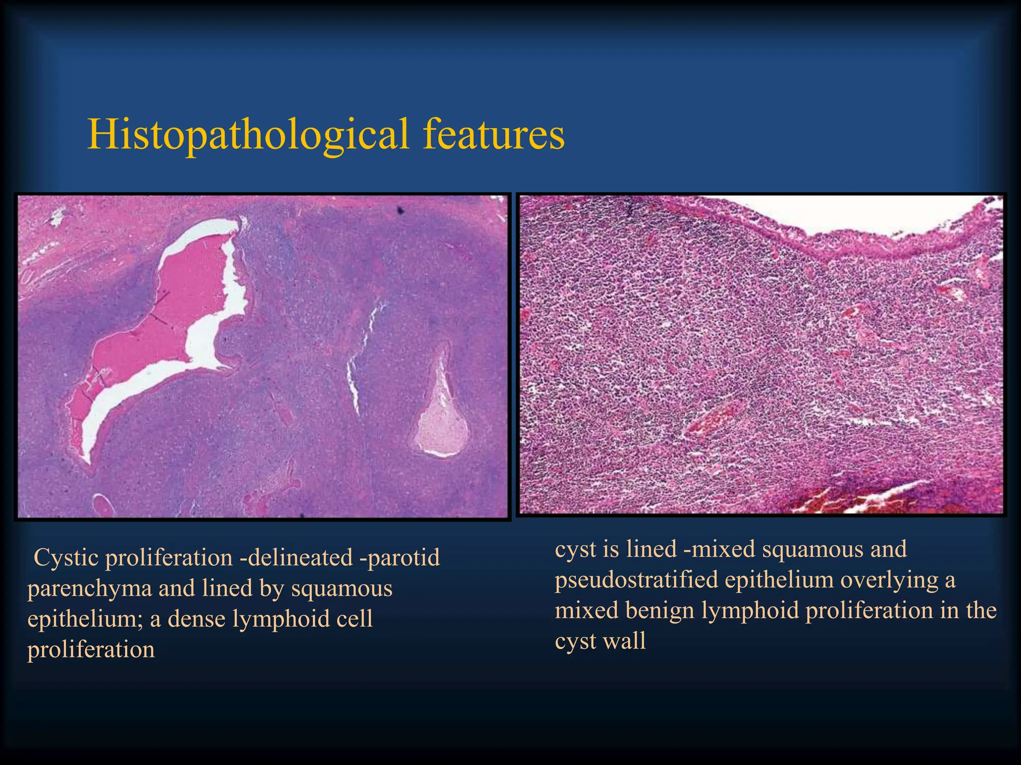 Benign lymphoepithelial-03.ppt lesions.. | PPT