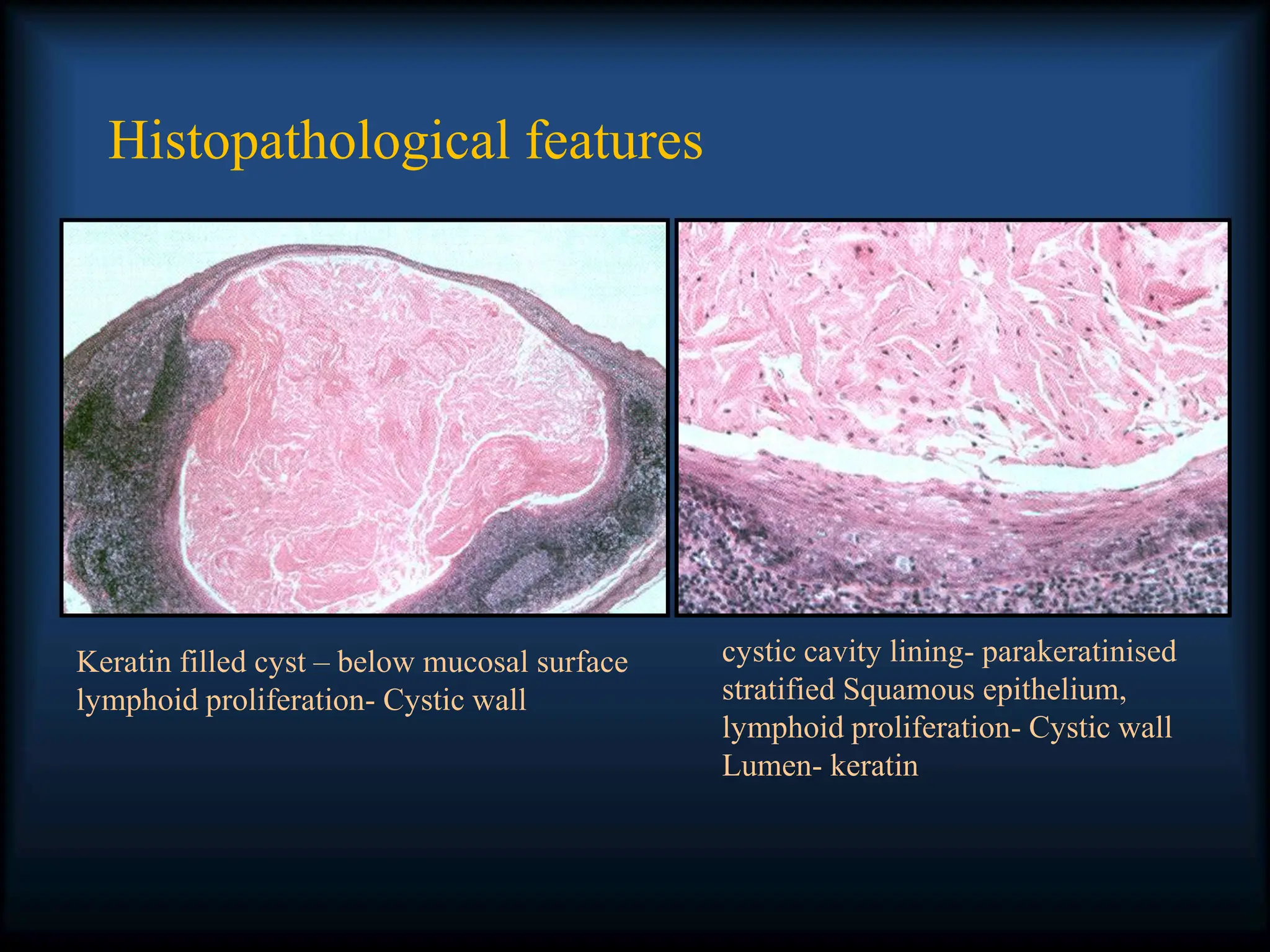 Benign lymphoepithelial-03.ppt lesions.. | PPT