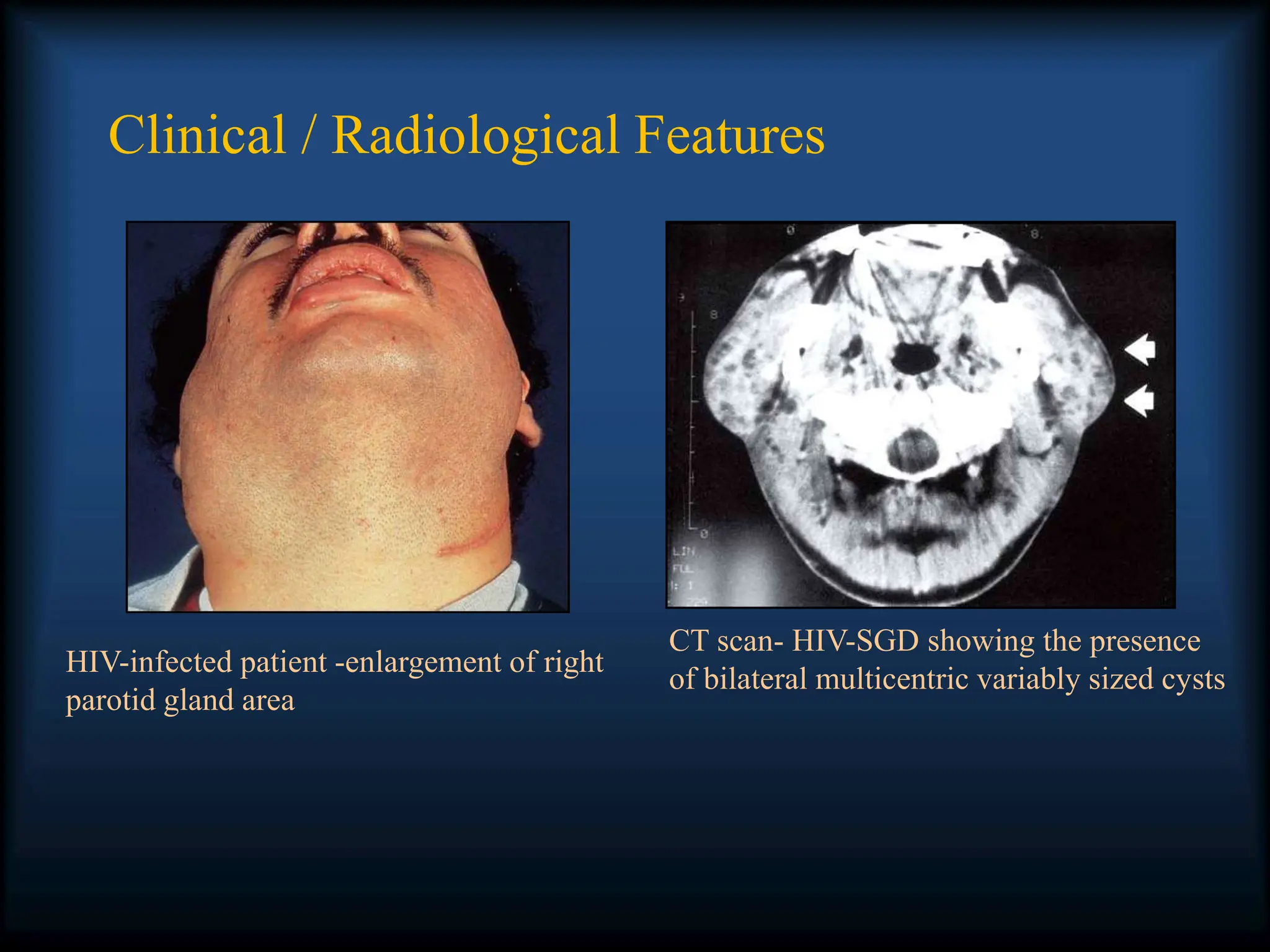 Benign lymphoepithelial-03.ppt lesions.. | PPT