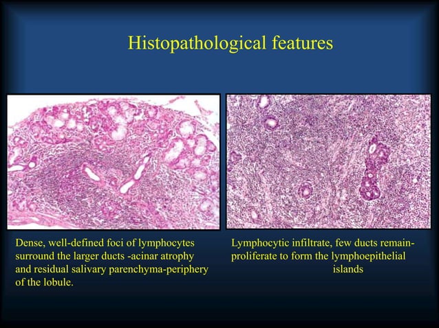Benign lymphoepithelial-03.ppt lesions.. | PPT | Ear, Nose and Throat ...