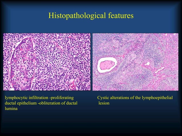 Benign lymphoepithelial-03.ppt lesions.. | PPT | Ear, Nose and Throat ...