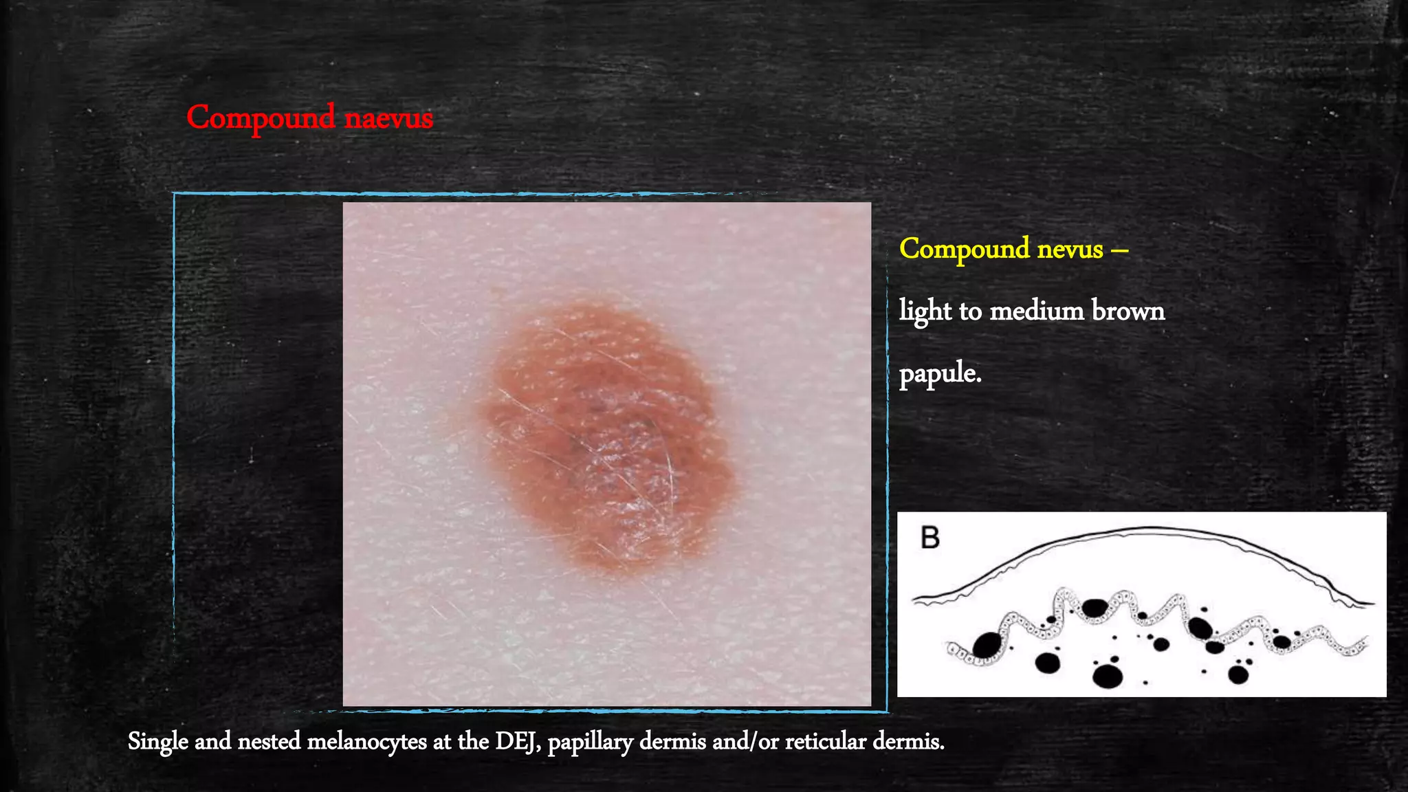 Benign Elanocytic Lesions | COMMON ACQUIRED MELANOCYTIC NEVI | PPTX