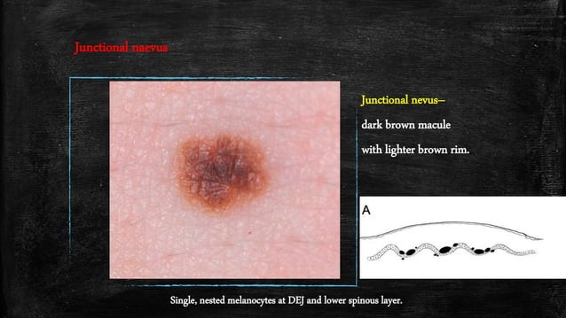 Benign Elanocytic Lesions | COMMON ACQUIRED MELANOCYTIC NEVI | PPTX ...