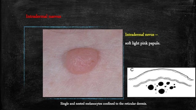 Benign Elanocytic Lesions | COMMON ACQUIRED MELANOCYTIC NEVI | PPTX ...