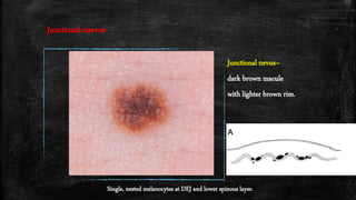Benign Junctional Nevus