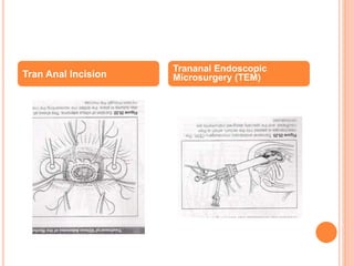 Benign Neoplasm of Colon and Rectum | PPTX