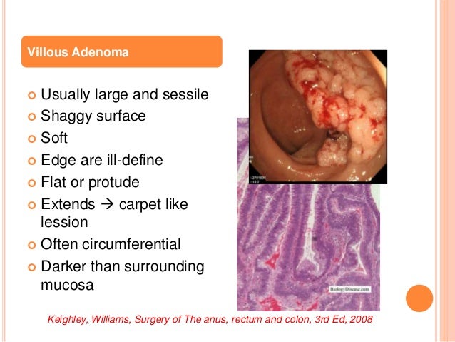 Benign Neoplasm of Colon and Rectum