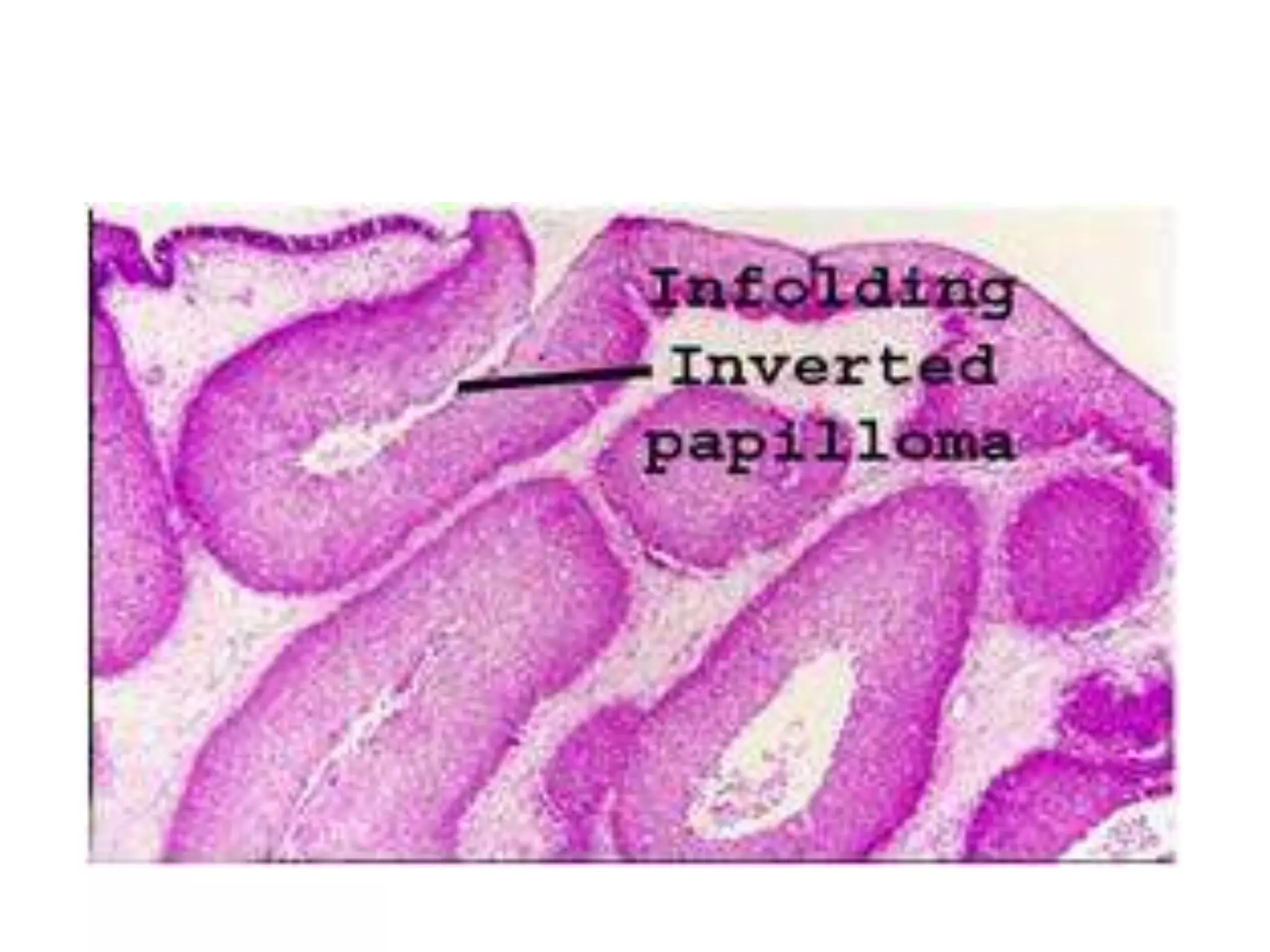 Benign neoplasm of nasal cavity | PPTX