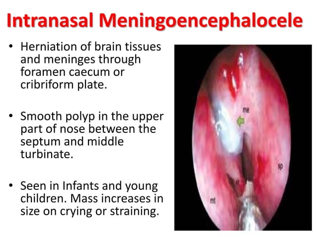 Benign neoplasm of nasal cavity | PPTX