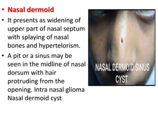 Benign neoplasm of nasal cavity | PPTX