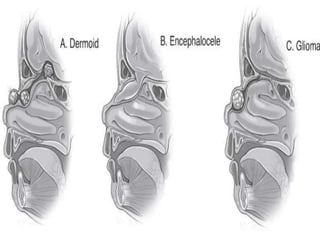 Benign neoplasm of nasal cavity | PPTX