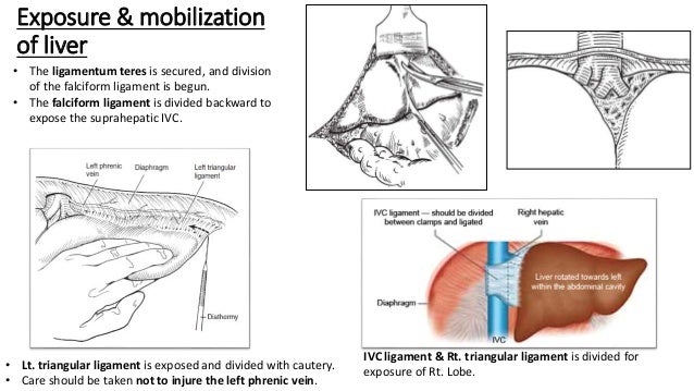 Benign Neoplasms Of Liver