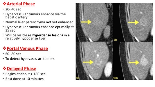 Benign neoplasms of liver
