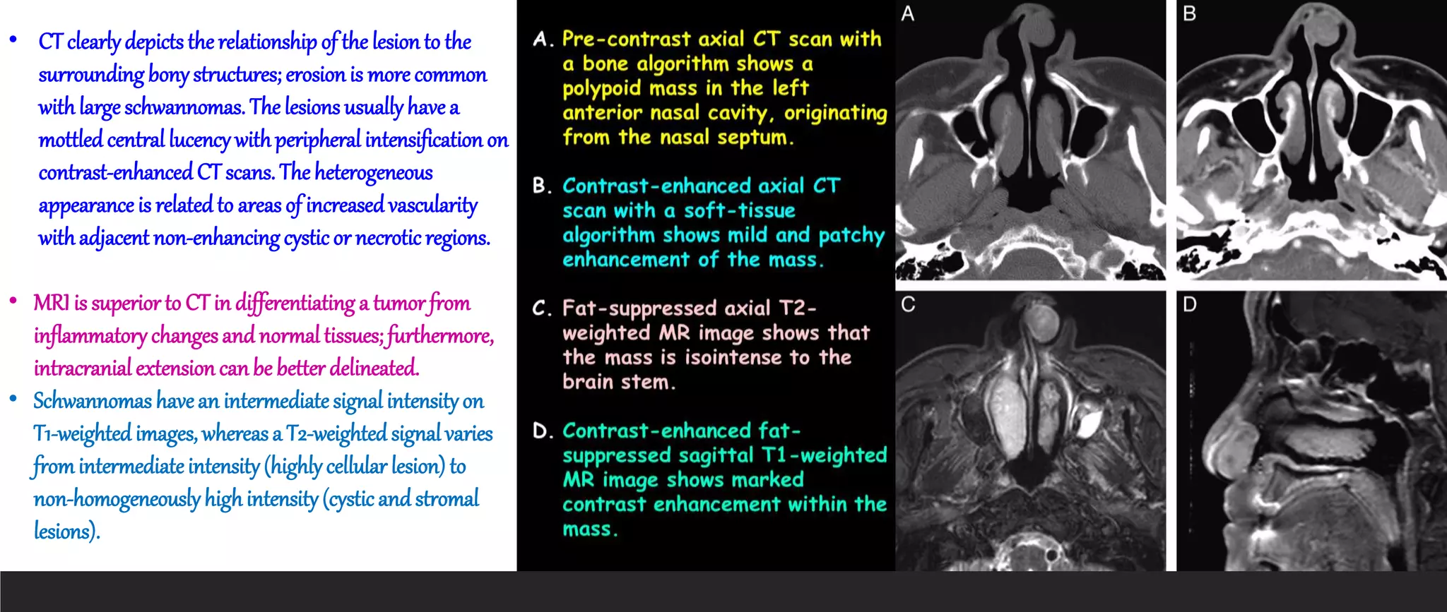 BENIGN NEOPLASMS OF THE NOSE AND PNS.pptx