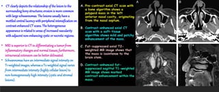 BENIGN NEOPLASMS OF THE NOSE AND PNS.pptx