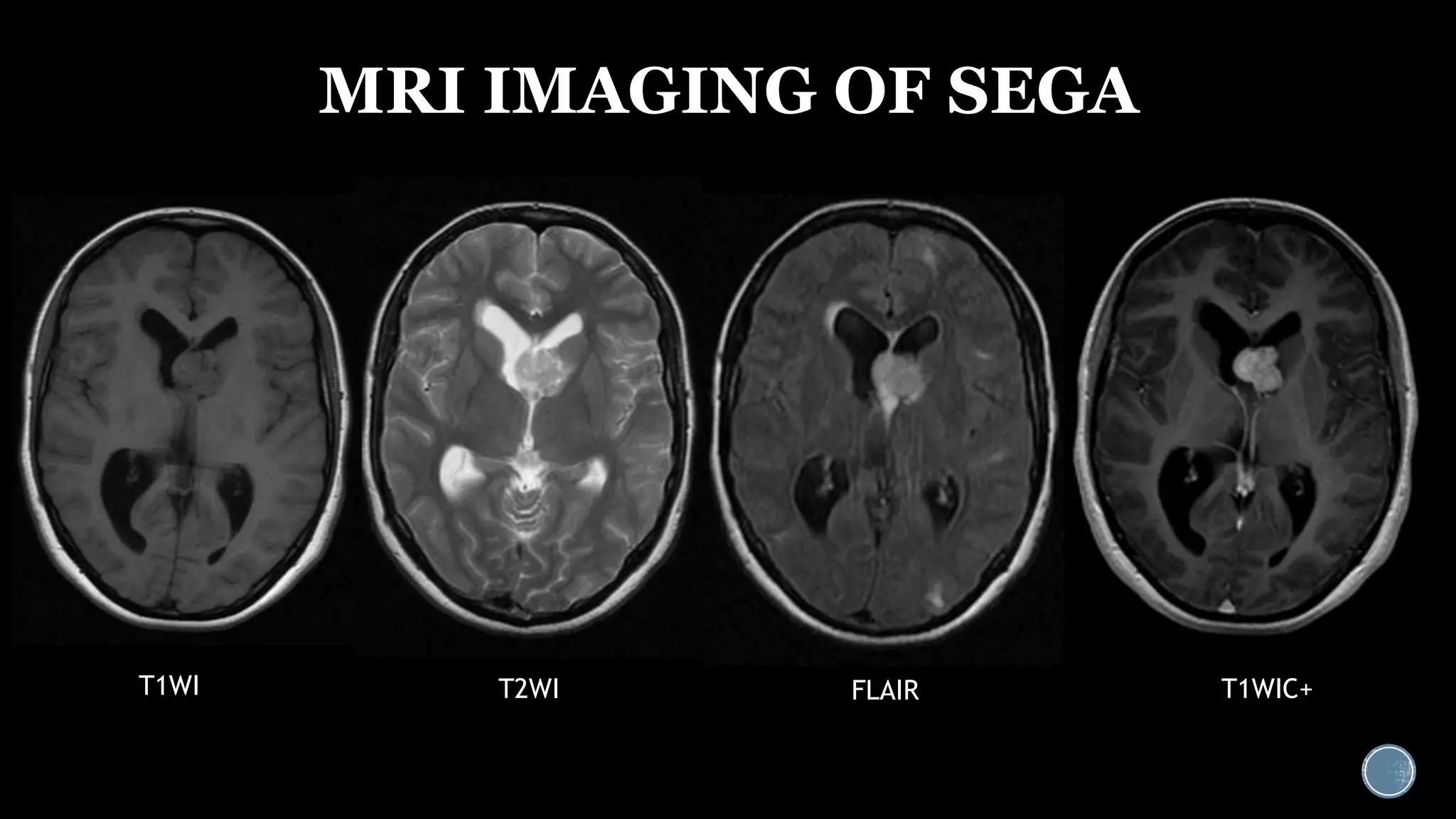 Benign neoplastic lesions of brain | PPT