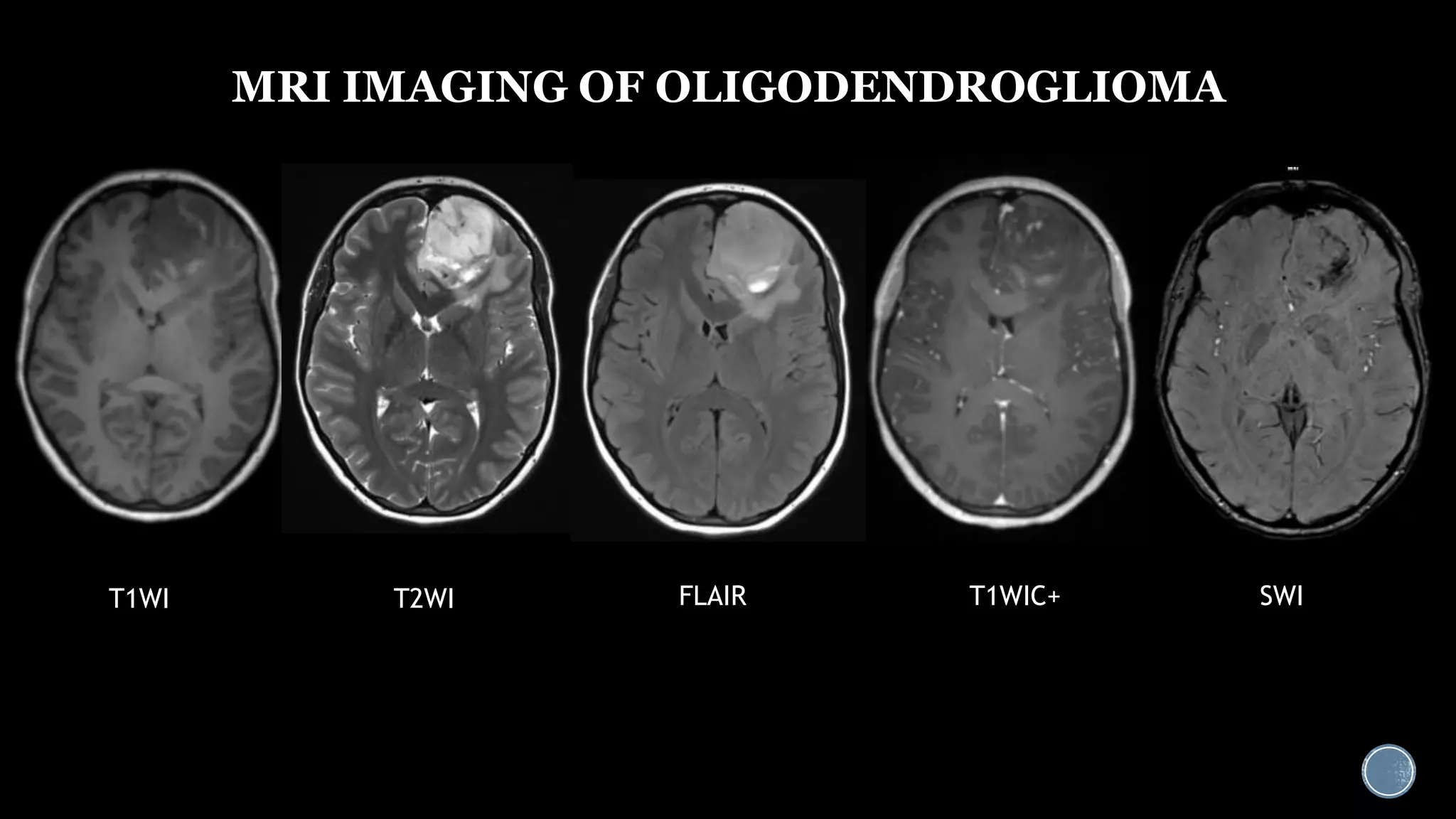 Benign neoplastic lesions of brain | PPT