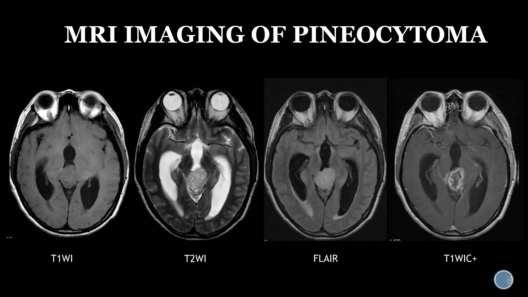 Benign neoplastic lesions of brain | PPT