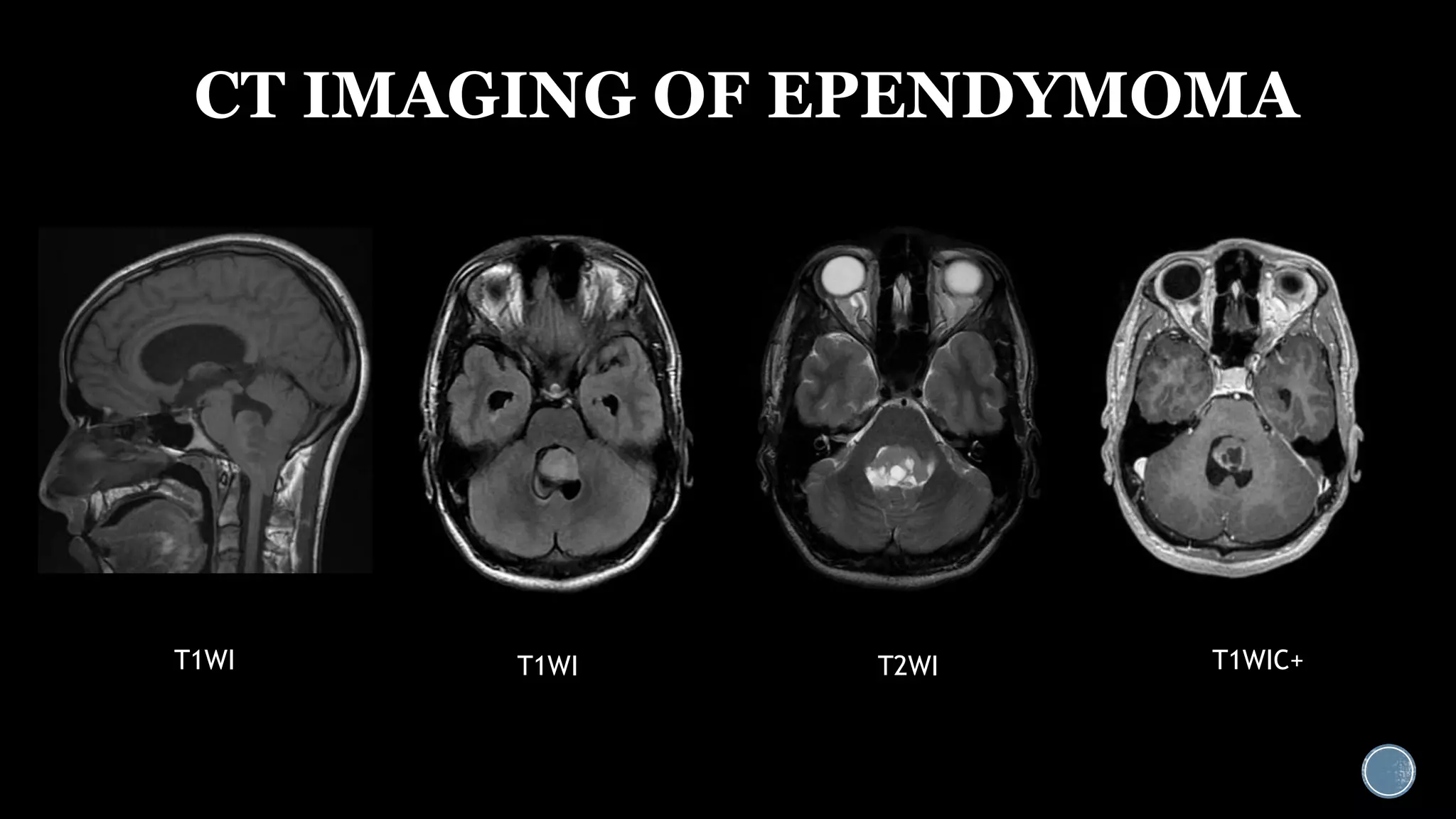 Benign neoplastic lesions of brain | PPT