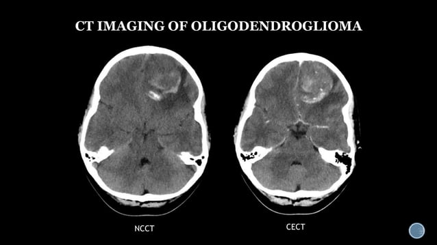 Benign neoplastic lesions of brain | PPT
