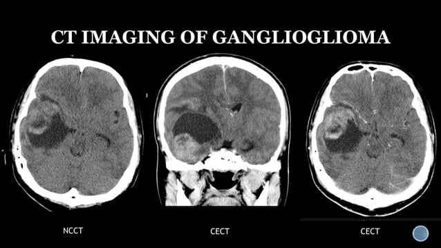 Benign neoplastic lesions of brain | PPT