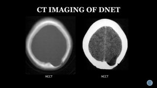 Benign neoplastic lesions of brain | PPTX