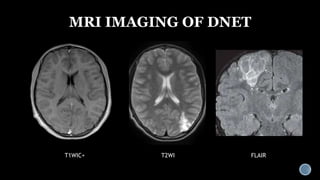 Benign neoplastic lesions of brain | PPTX