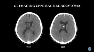 Benign neoplastic lesions of brain | PPTX