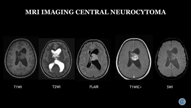 Benign neoplastic lesions of brain | PPT