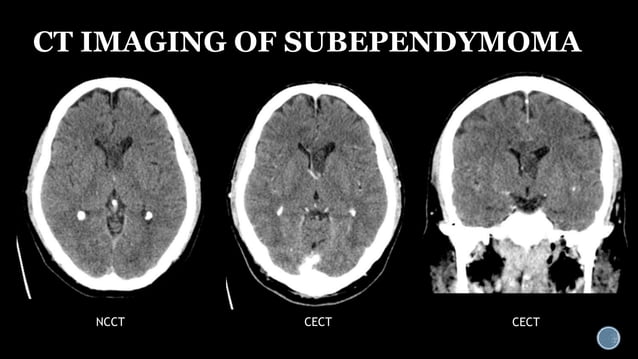 Benign neoplastic lesions of brain | PPT