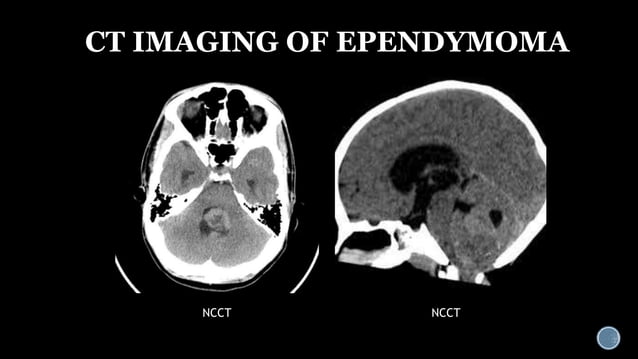 Benign neoplastic lesions of brain | PPT