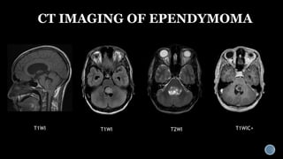 Benign neoplastic lesions of brain | PPTX