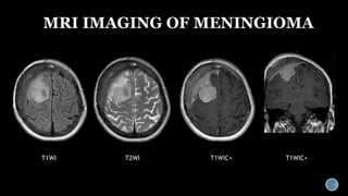 Benign neoplastic lesions of brain | PPTX