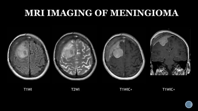Benign neoplastic lesions of brain | PPT