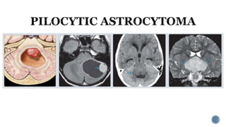 Benign neoplastic lesions of brain | PPTX