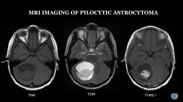 Benign neoplastic lesions of brain | PPT