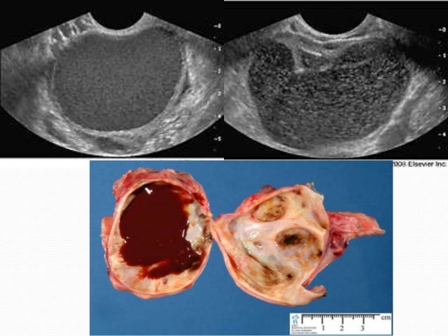 Benign ovarian tumours