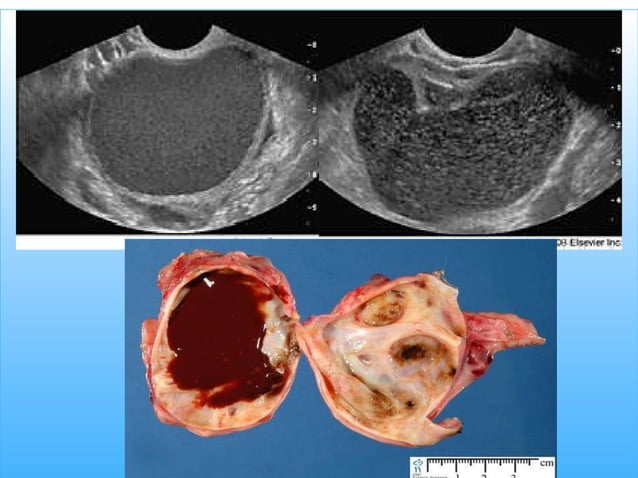 Benign ovarian Neoplasms Dr.H.K.Cheema-Professor-OBG.PIMS,Jalandhar | PDF