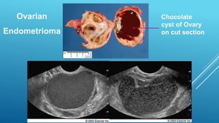 Benign ovarian tumours | PPTX