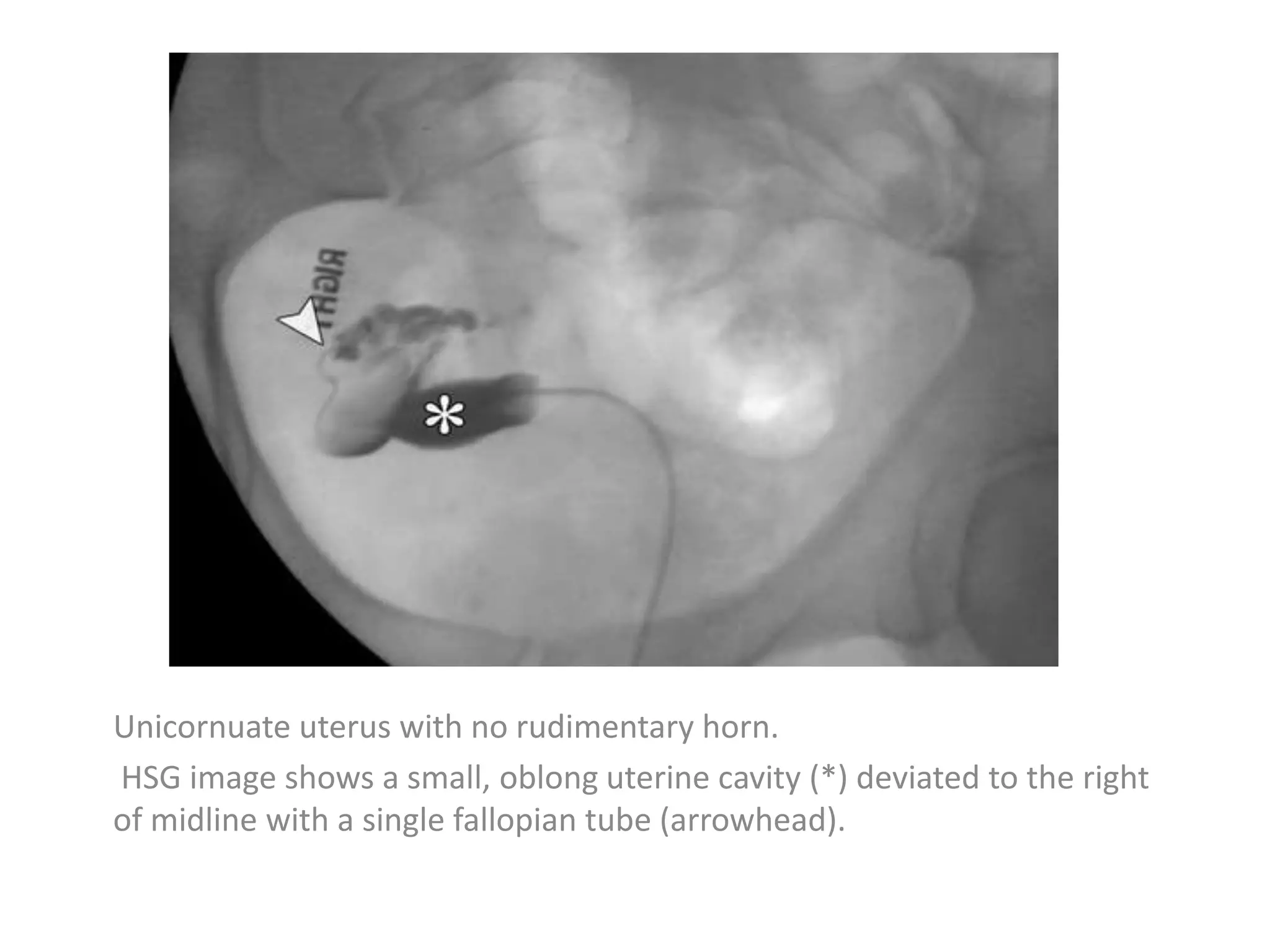 Benign pelvic diseases in females 2 | PPTX