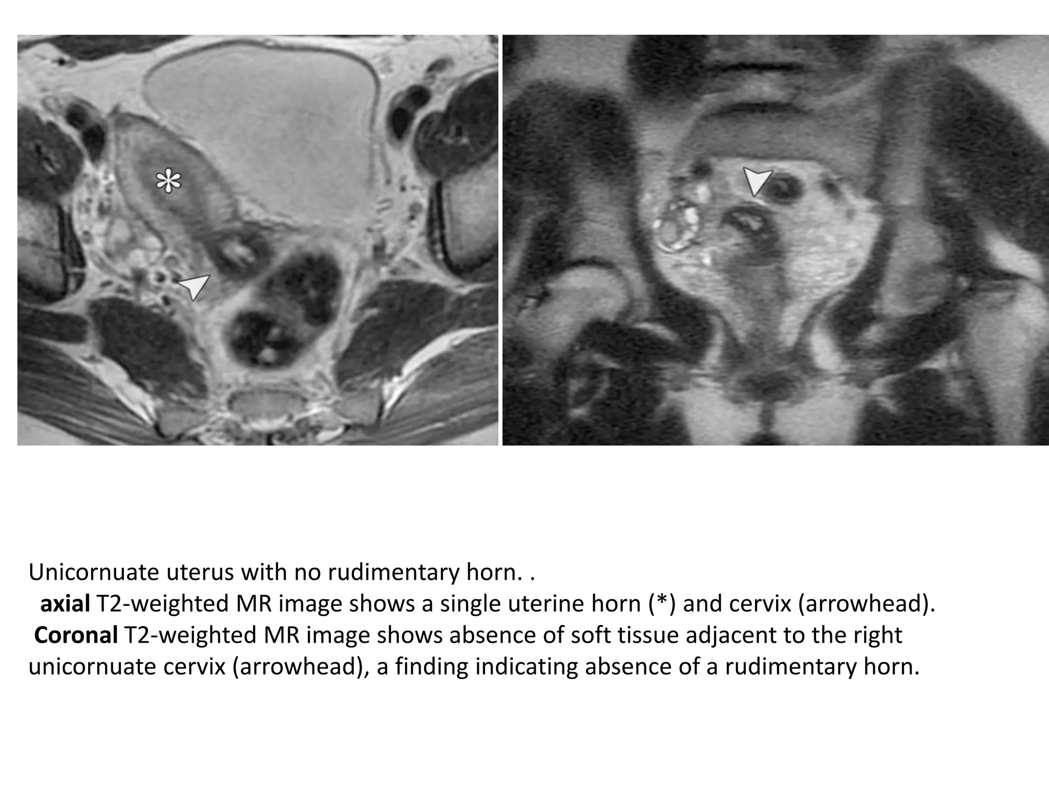 Benign pelvic diseases in females 2 | PPTX