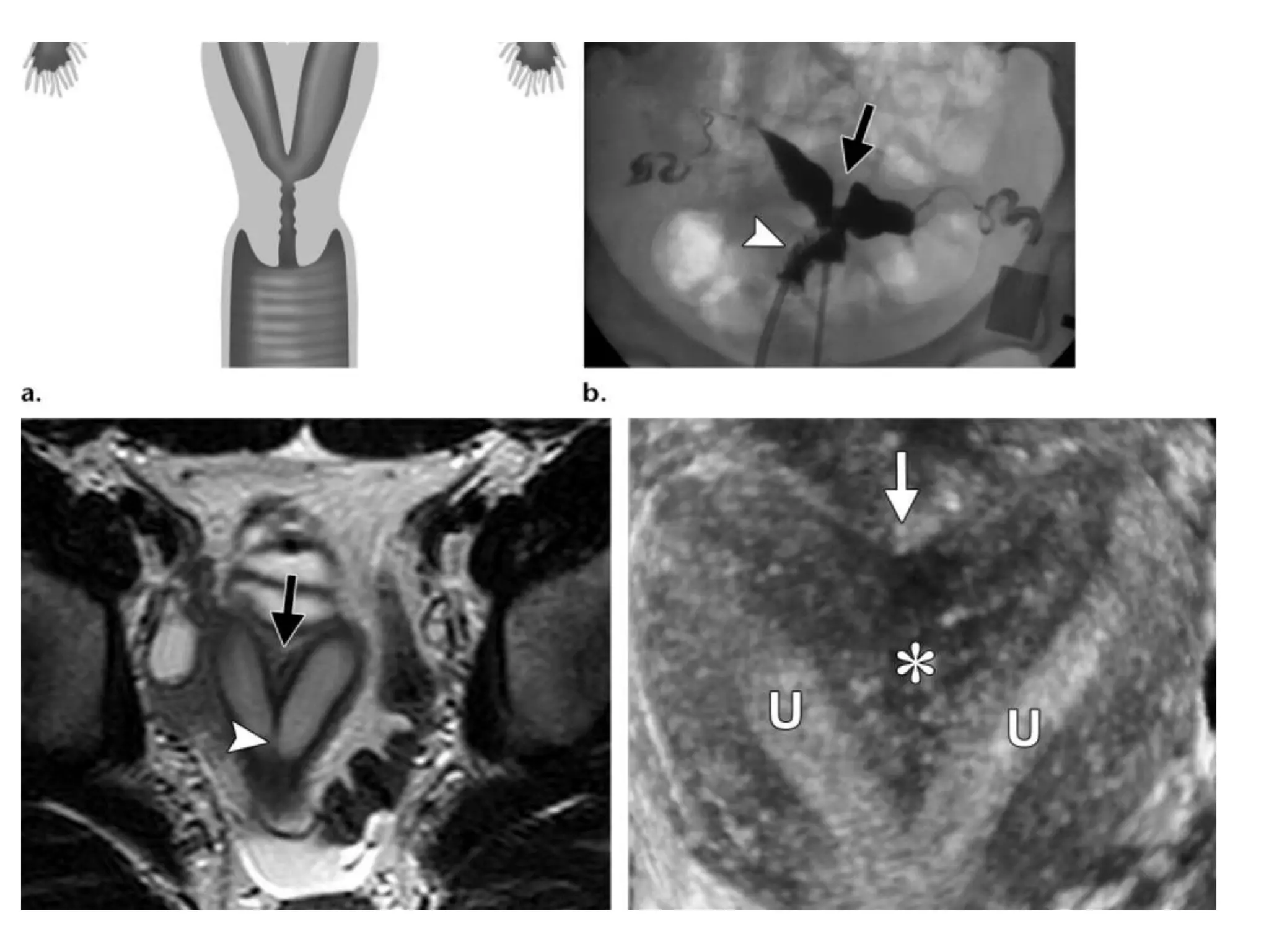 Benign pelvic diseases in females 2 | PPTX