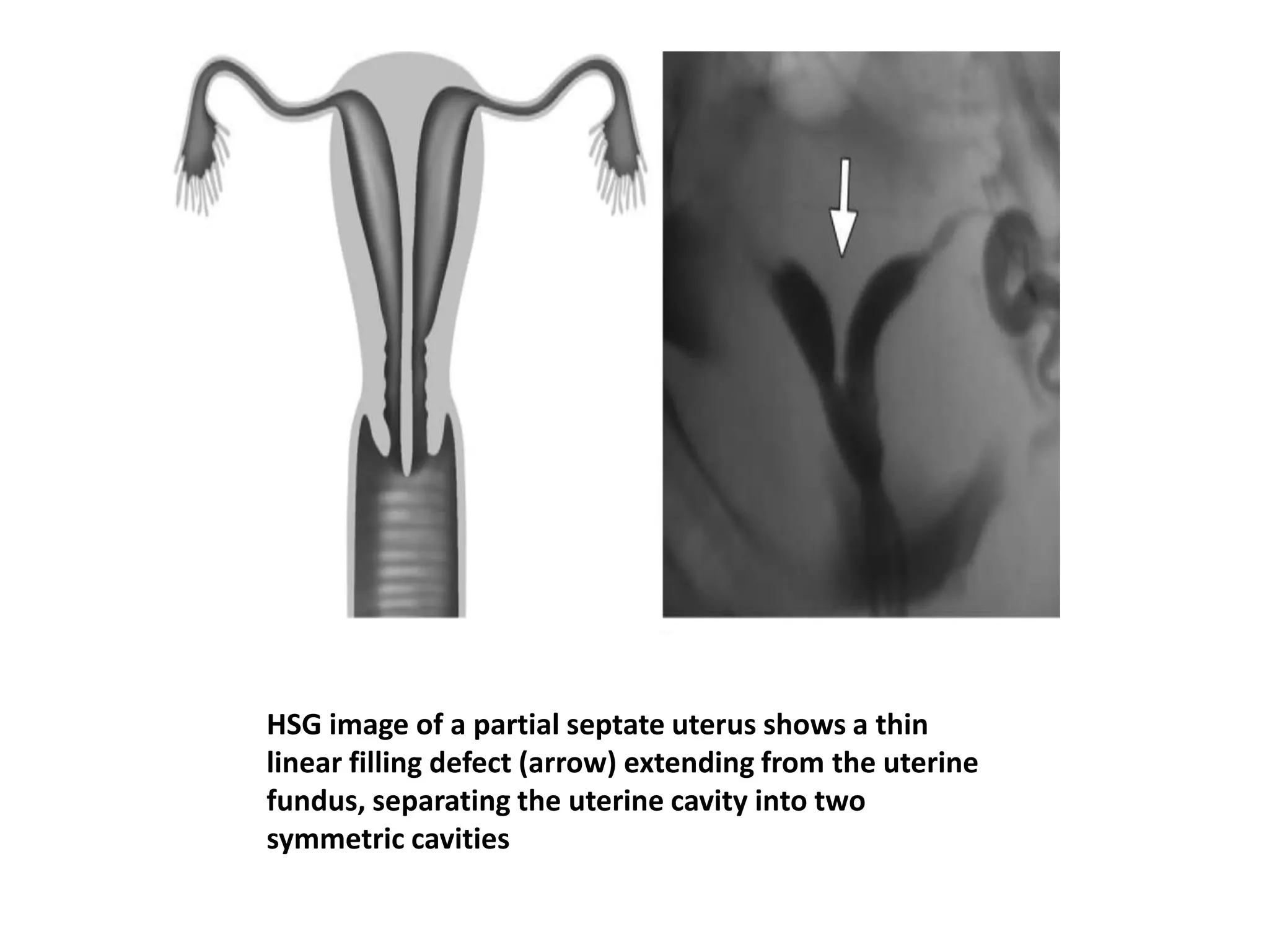 Benign pelvic diseases in females 2 | PPTX