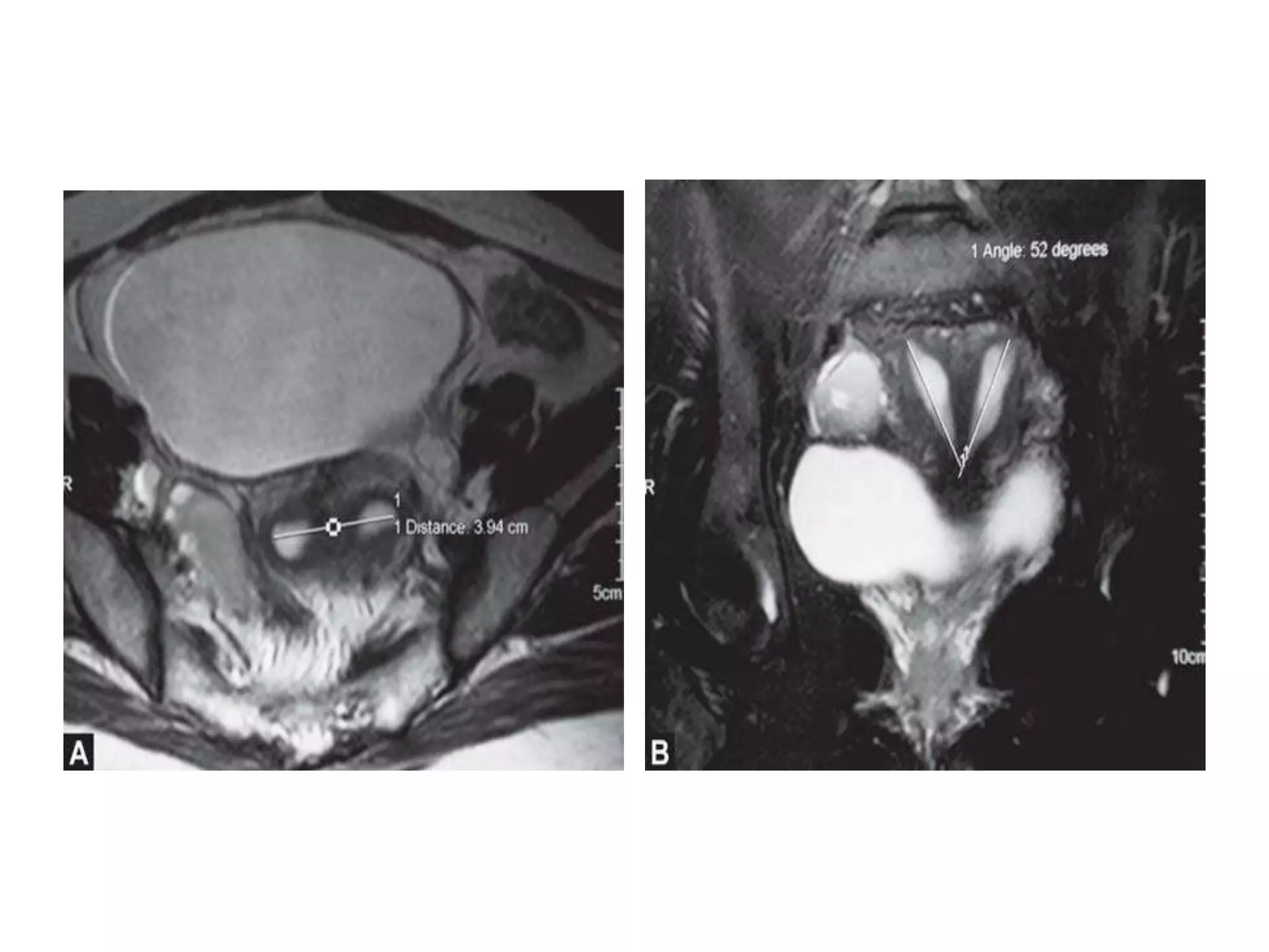 Benign pelvic diseases in females 2 | PPTX